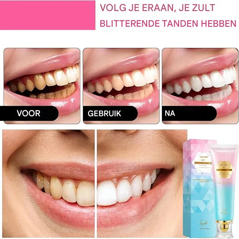 PureTeeth™ - Bescherm uw tandvlees tijdens het bleken van uw tanden