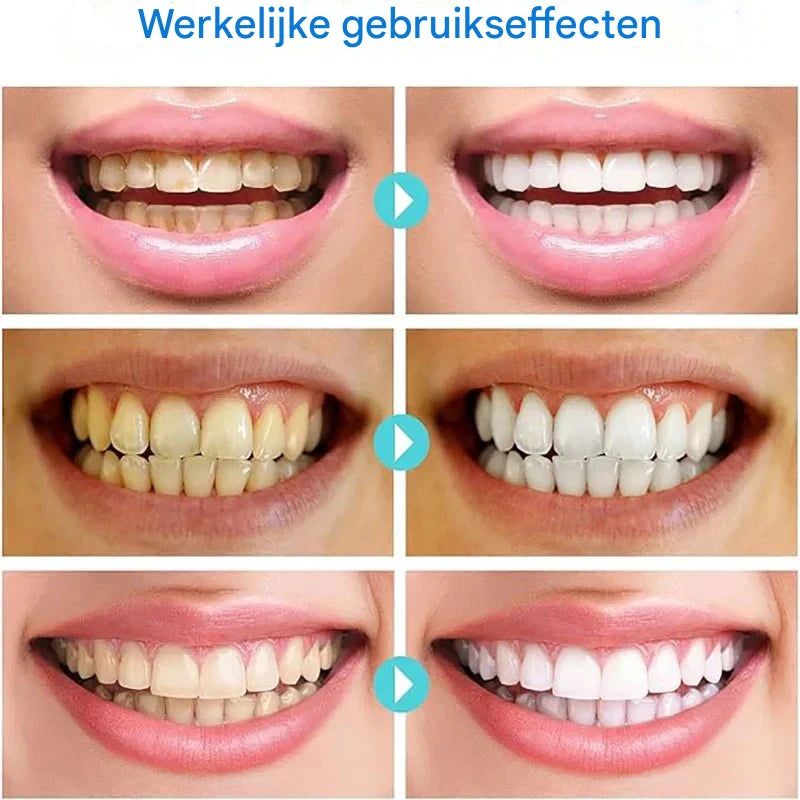 PureTeeth™ - Bescherm uw tandvlees tijdens het bleken van uw tanden